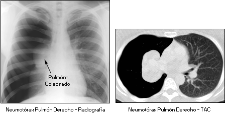 Enfermeras a cuadros: Colapso pulmonar.