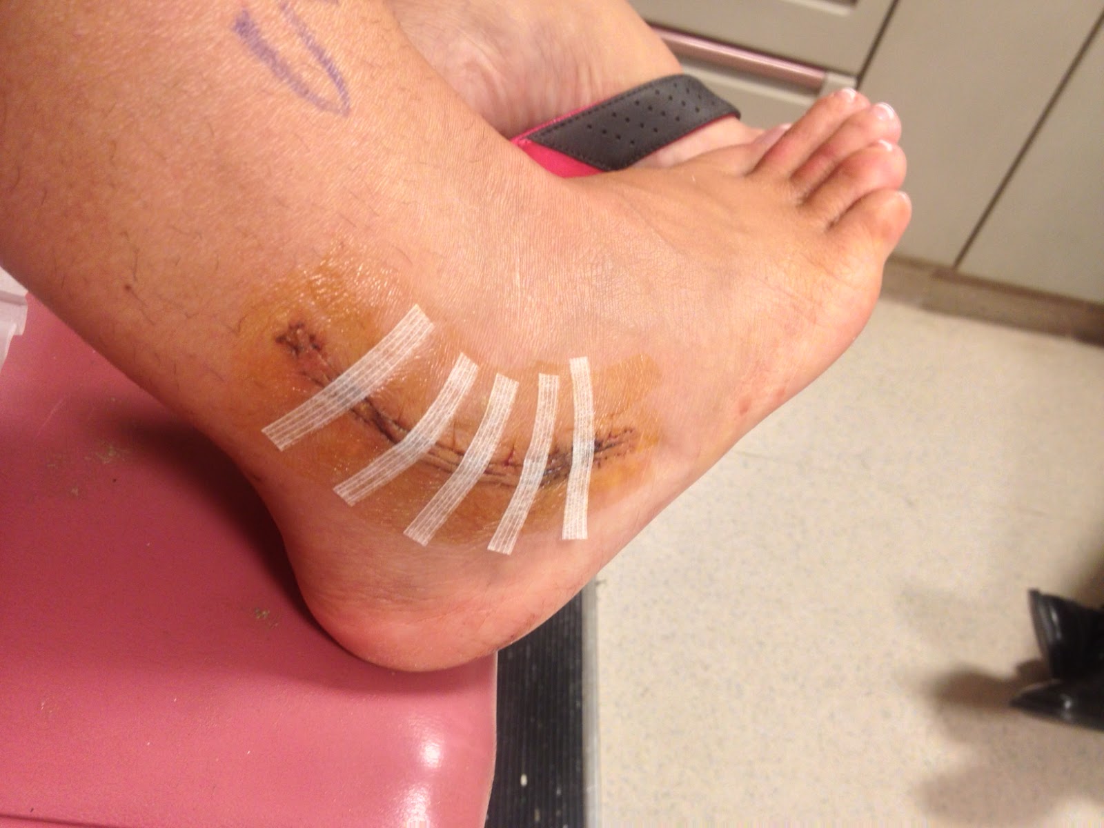 The surgical recovery of and surviving a fully ruptured peroneal long ...