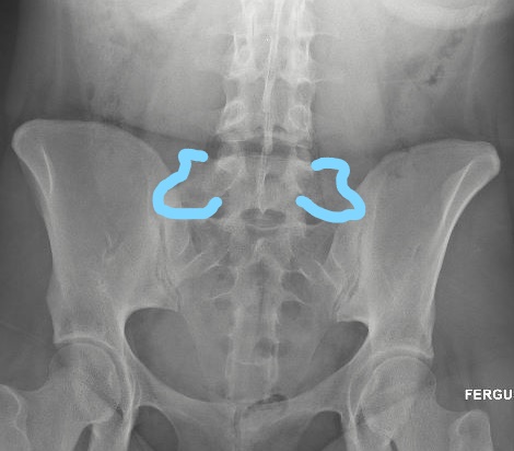 Bertolotti’s Syndrome | Growing Spine Blog | Washington University in St. Louis