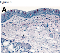 Avian Flu Diary: EID Journal: Pathology and Pathogenesis of Fatal SARS ...
