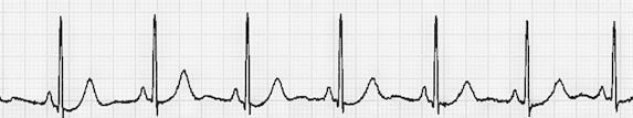 MedicEd makes it simple: Fast Rhythms_The Tachycardias