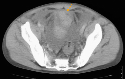 Bladder Rupture-CT - Sumer's Radiology Blog