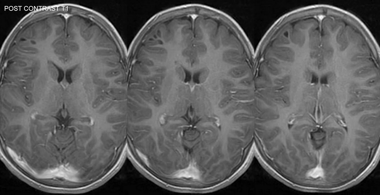 Dr Balaji Anvekar FRCR: Frontal subcortical white matter cystic lesions MRI