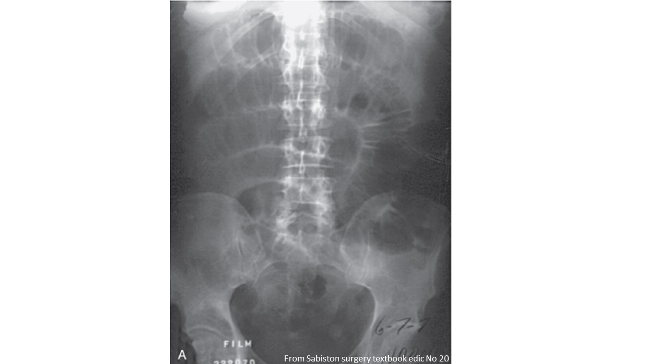 Obstrucción Intestinal