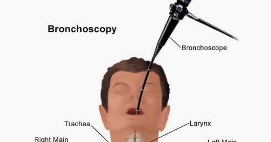 Récap' IDE: La fibroscopie bronchique