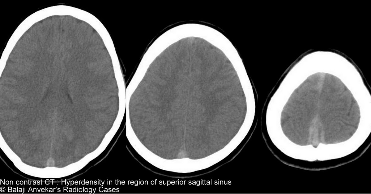 Neuroradiology Cases: Hyperdense sinus on CT Brain