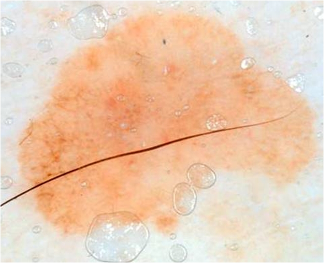 Dermatoscopia: Fingerprinting & Fat Fringers