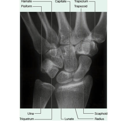Carpal Bone X Ray