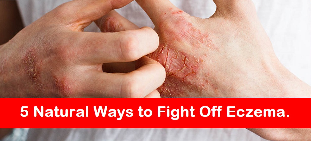 5 Natural Ways to Fight Off Eczema.