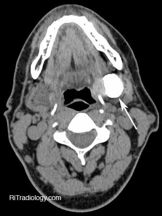 RiT radiology: Sialolithiasis