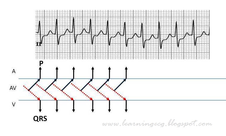 Supraventricular Tachycardia Rhythm Strip