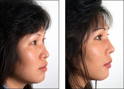 SG Rhinoplasty - Singapore Nose Job & Surgery