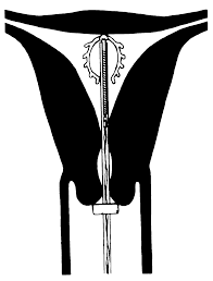 Technical aspects of intra-uterine contraceptive device (IUCD)