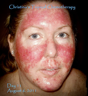 My Journey Through Topical Chemotherapy - Fluorouracil 5% Cream and ...