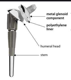 UW Shoulder and Elbow Academy: Metal back, uncemented glenoid ...