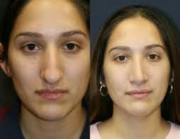 Medical Treatment Pictures-for Better Understanding: Septoplasty ...