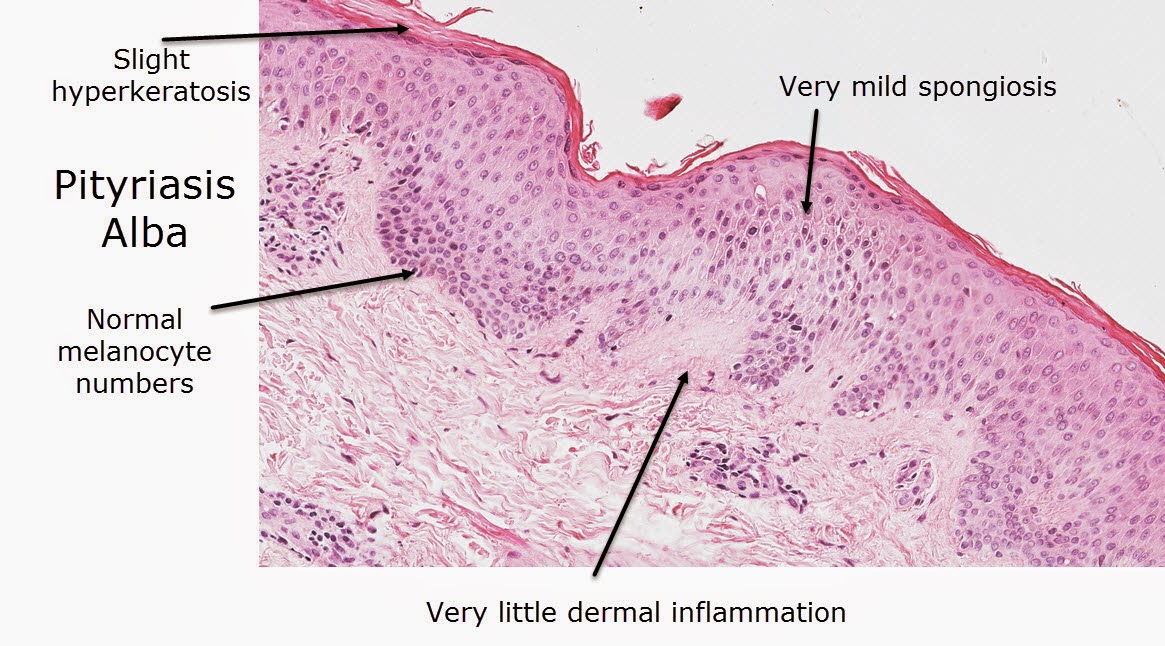 Dermatopathology Made Simple - Inflammatory: Psoriasiform Reaction Pattern