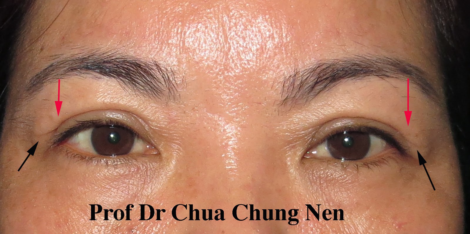 Eyelid Surgery by Prof Dr CN CHUA 蔡鐘能: Alternative to upper ...