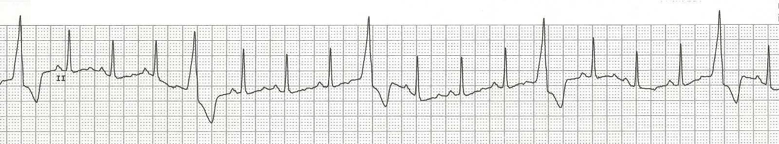 ECG Rhythm Strips 90