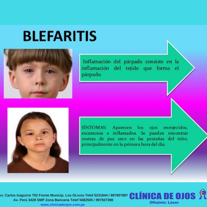 Clínica de Ojos Oftalmic Láser: BLEFARITIS Clínica de Ojos Oftalmic Láser: BLEFARITIS