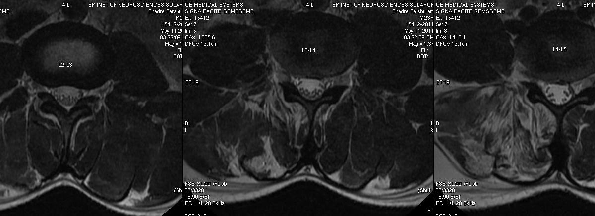 Neuroradiology Cases: Atrophy of paraspinal muscles