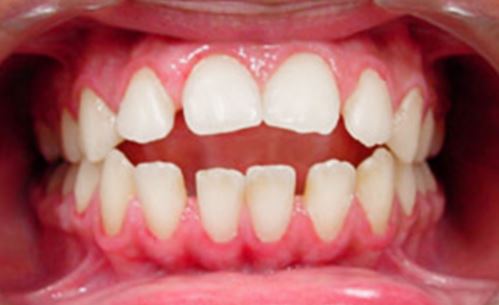 Causes of Open bite, Deep bite, crowding, Generalized spacing, Midline ...