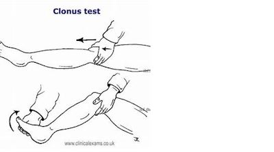 easyhumanatomy: clonus : sign of upper motor neuron