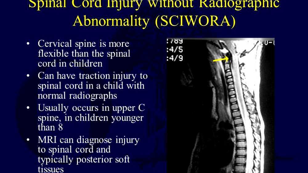 Spinal cord injury without radiographic abnormality