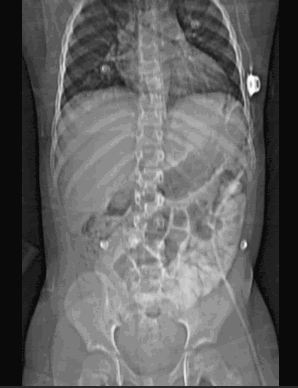 blog Rx,Tc e Rm....: APENDICITE AGUDA