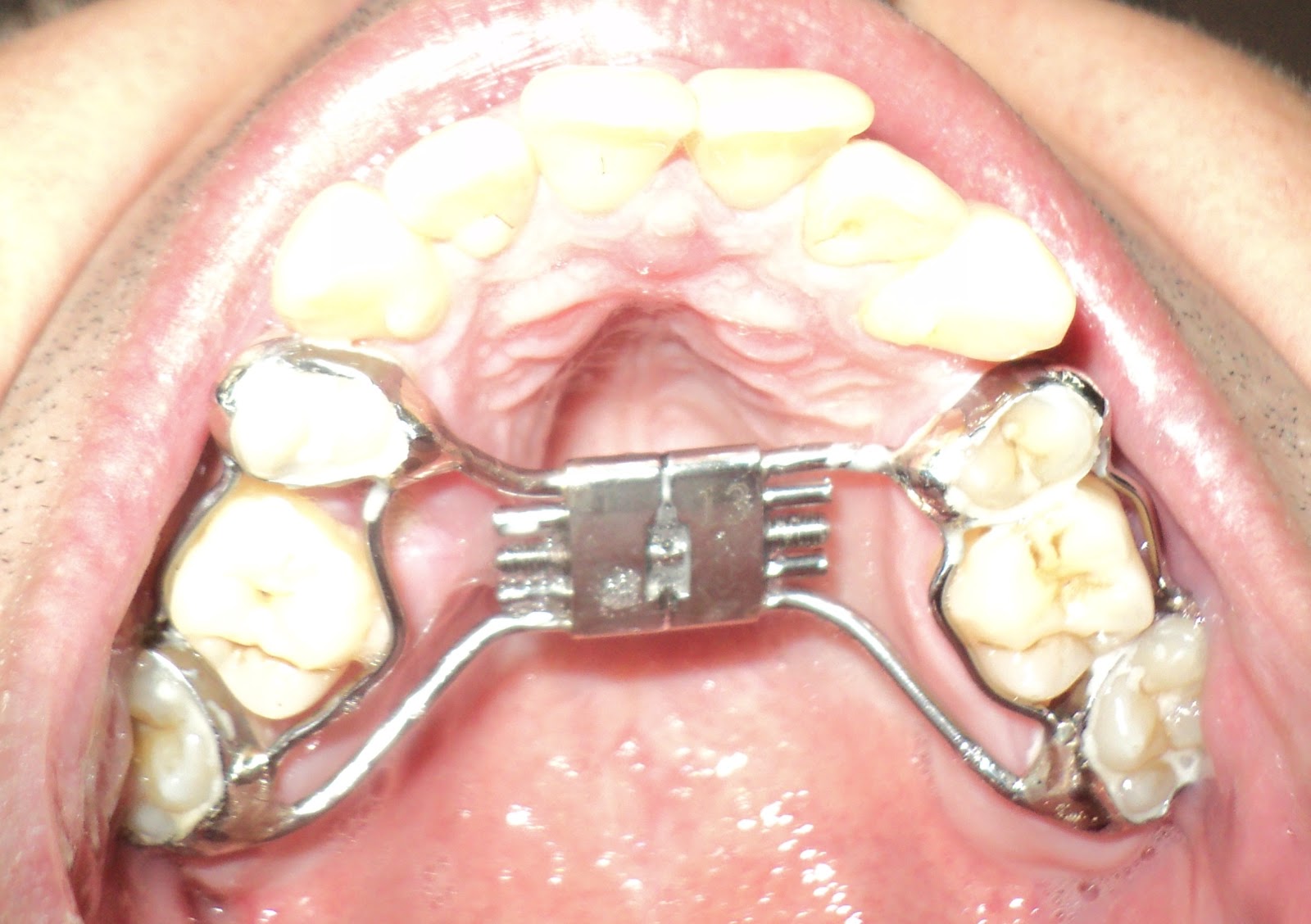 Diário: Minha Cirurgia Ortognática: Início do tratamento ortodôntico e ...