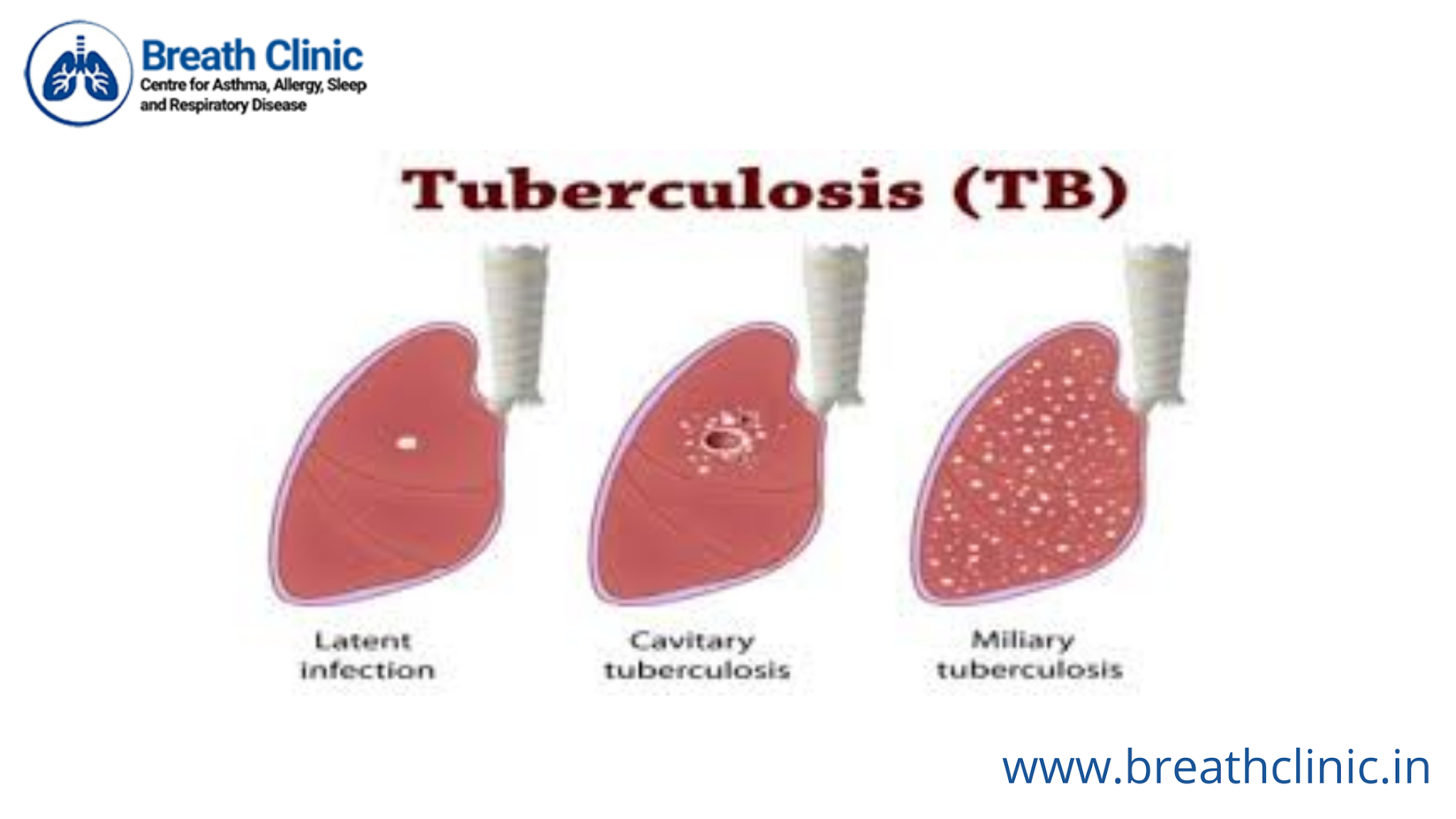 What are the three stages of TB?