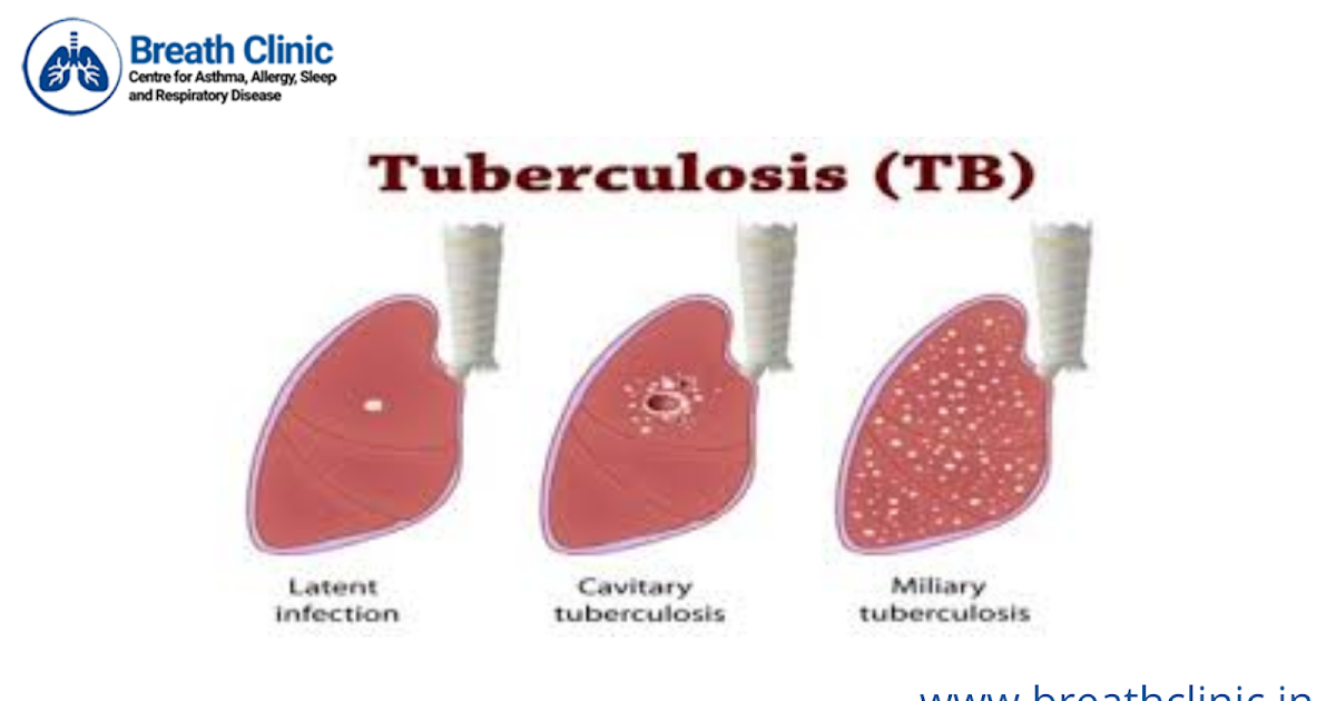 What are the three stages of TB?