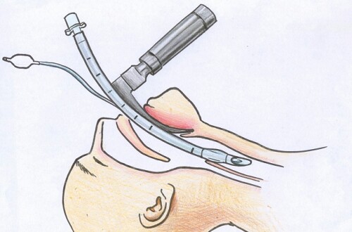 Fungsi Laringoskop dan Tujuan Pemasangan ETT dalam Pembiusan - Medianers