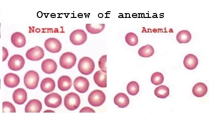 Overview of anemias - Definition of Anemia