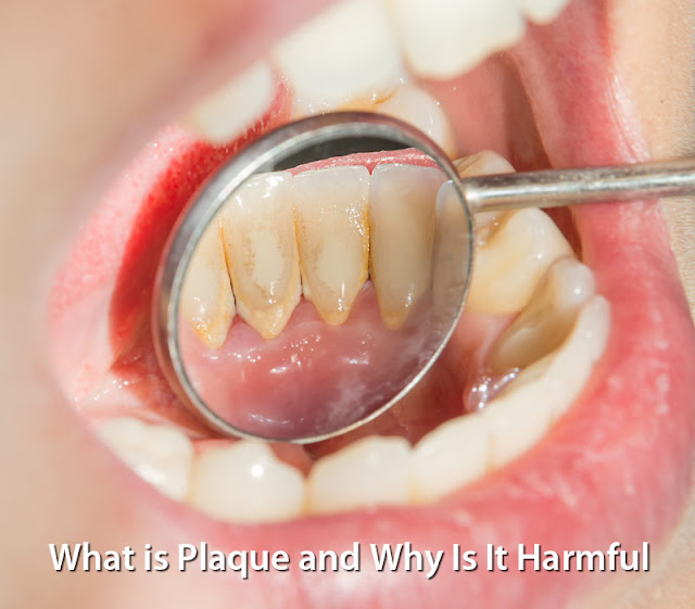 What is Plaque and Why Is It Harmful?