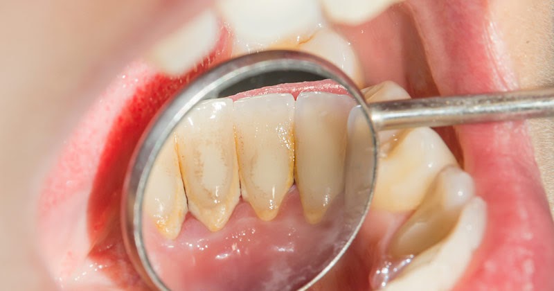 What is Plaque and Why Is It Harmful?