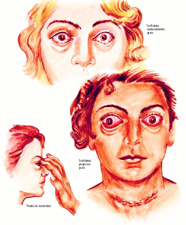 la maldición de observarlo todo: Hipotiroidismo