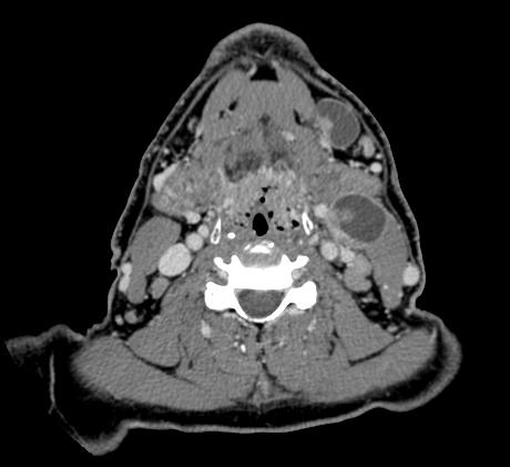 Roentgen Ray Reader: Cystic Lymph Nodes in Head and Neck Squamous Cell ...