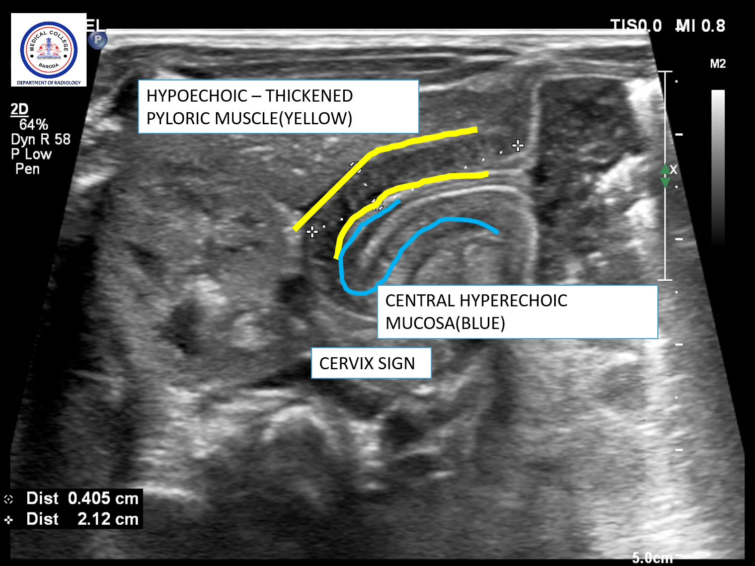 CONGENITAL HYPERTROPHIC PYLORIC STENOSIS