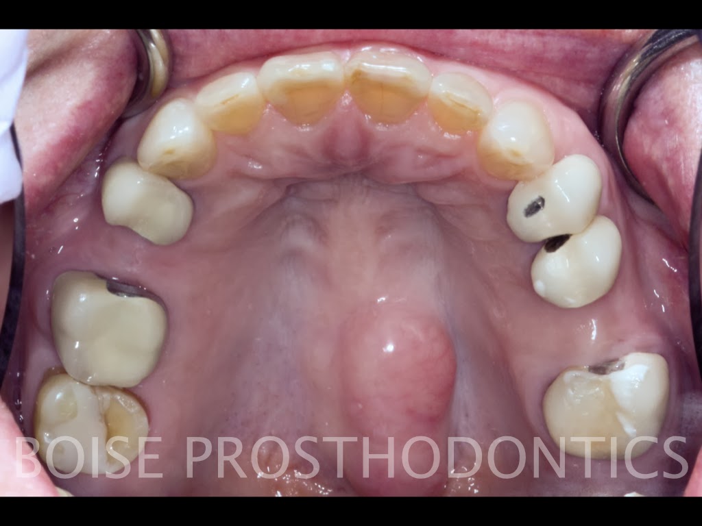 Boise Idaho Prosthodontics: Posterior Fixed Rehabilitation (limited ...