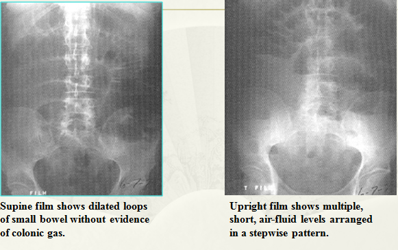 Learn Medicine Quickly: Intestinal Obstruction