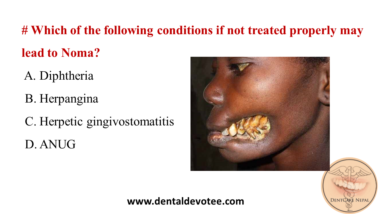 Dentosphere : World of Dentistry: Condition which may lead to Noma