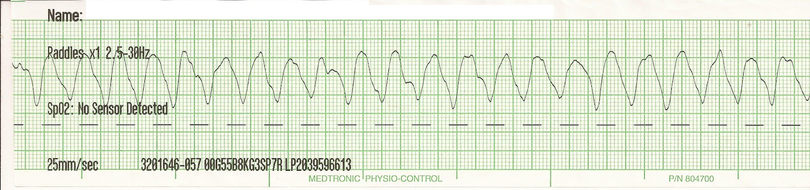 Pediatric cardiac arrest: PEA