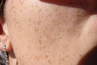 What are freckles? | Facts About All