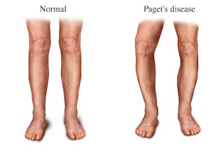Paget’s disease