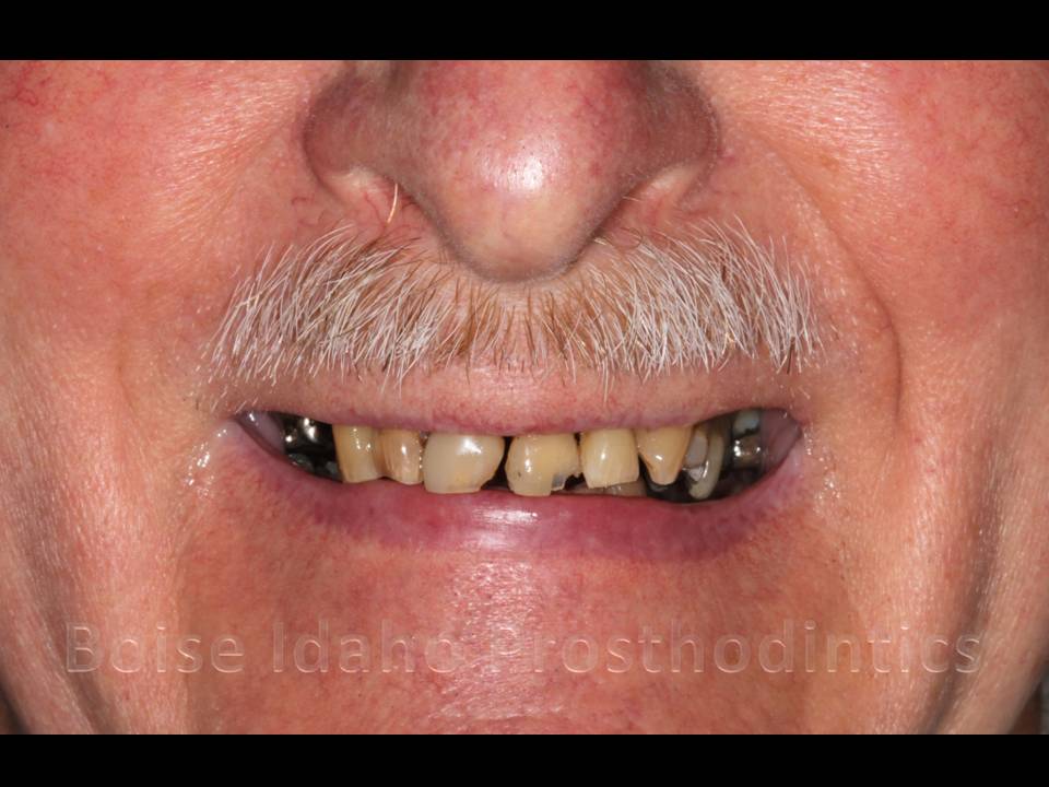 Boise Idaho Prosthodontics: Maxillary Semi-precision RPD with survey ...