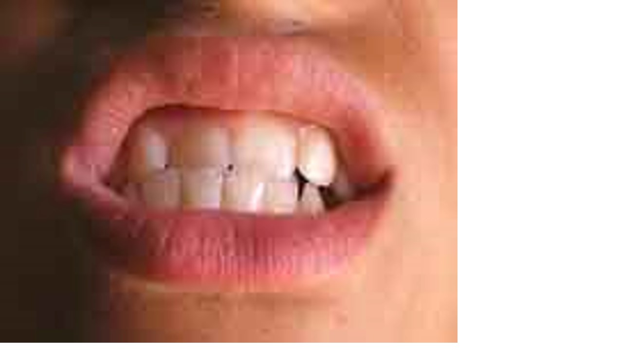 Tipos de Mordida y Malformaciones Dentarias