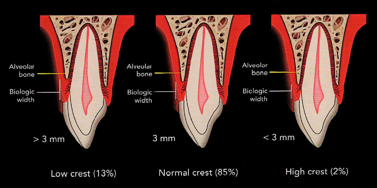 Clinical techniques for tissue management | Dental Esthetics