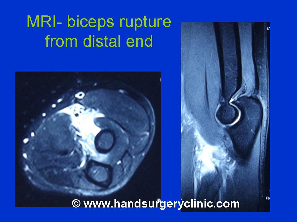 MRI Musculo-Skeletal Section: Biceps injury