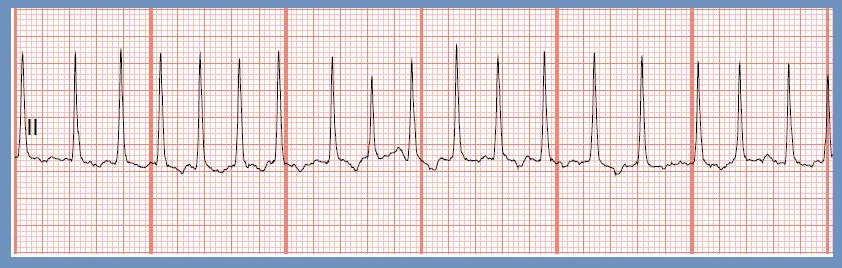 Float Nurse: EKG Rhythm Strip Quiz 133